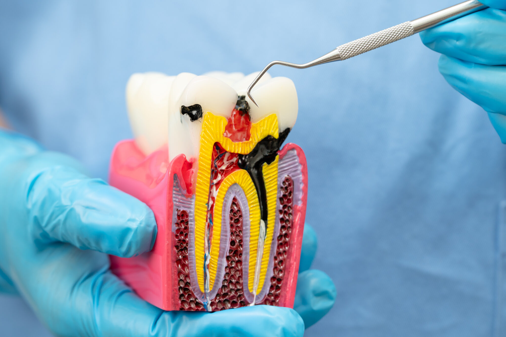 How We Help Aching Teeth With A Root Canal | Kansas City, MO